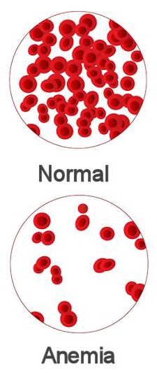 Anemia - Symptoms, Causes, Diagnosis and Ayurvedic Treatment